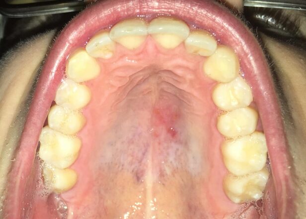Why Does the Roof of My Mouth Hurt? Causes and Remedies